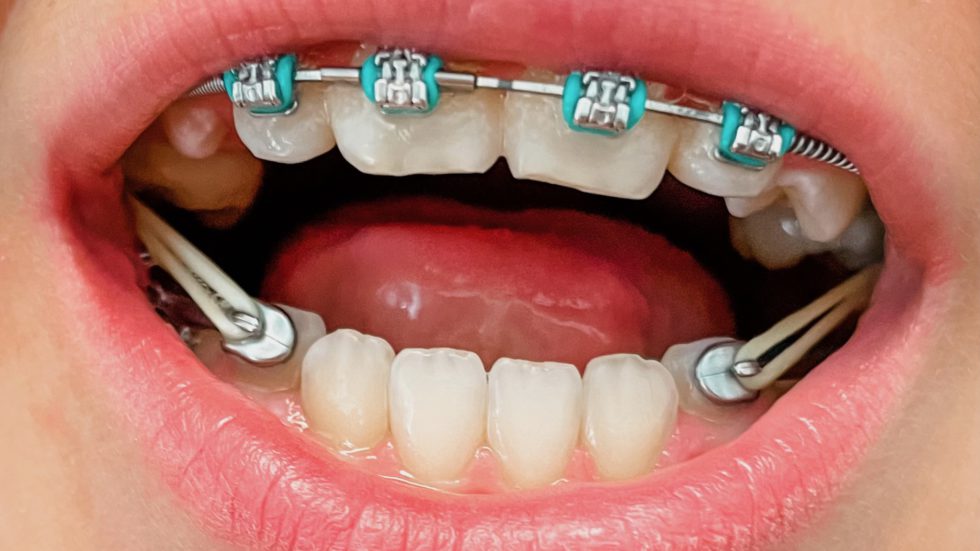 Why should you wear your rubber bands? - Best Orthodontics